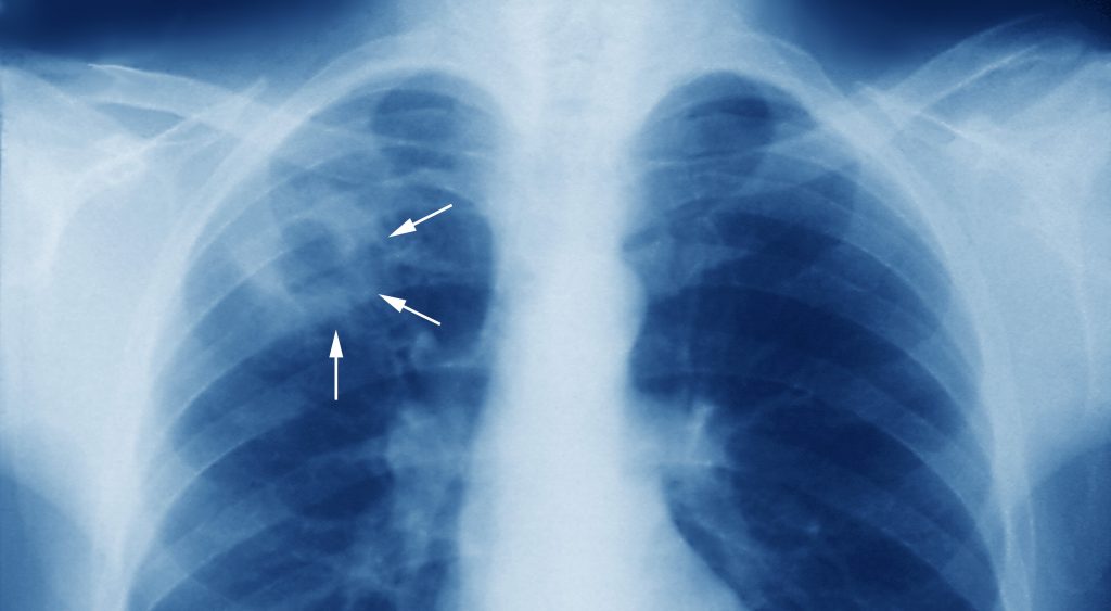 El Granuloma Tuberculoso Y El MTBC. Descubre La Tuberculosis.