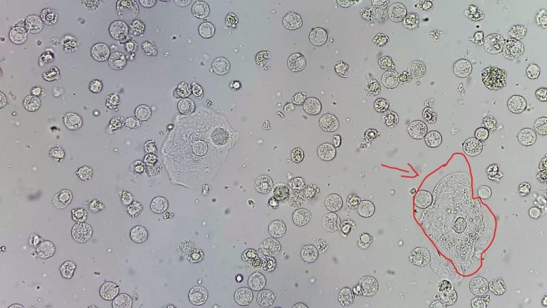 La Orina Y Su Análisis En El Laboratorio Clínico